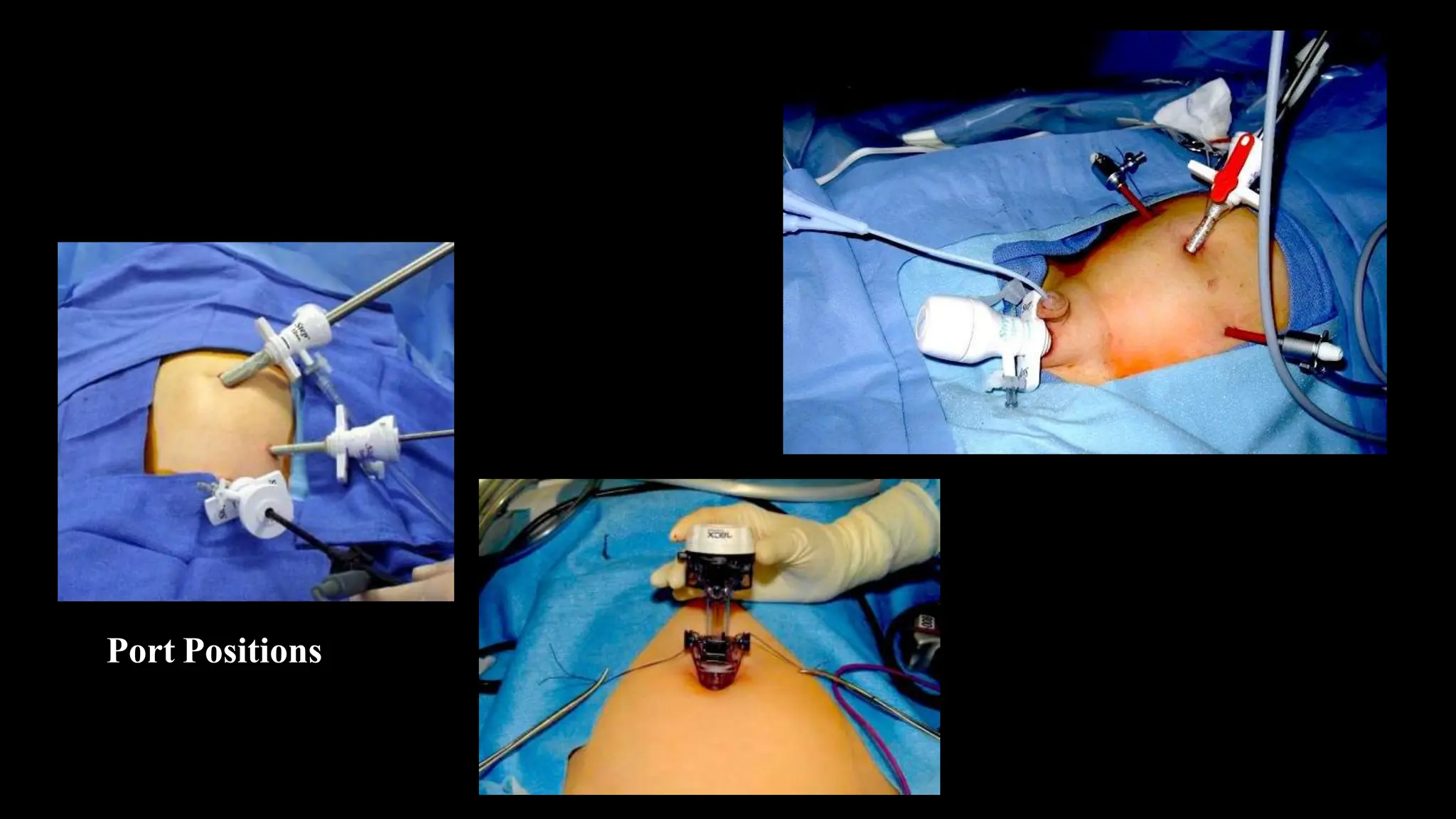 Abdominal Access Techniques in laparoscopy | PPT