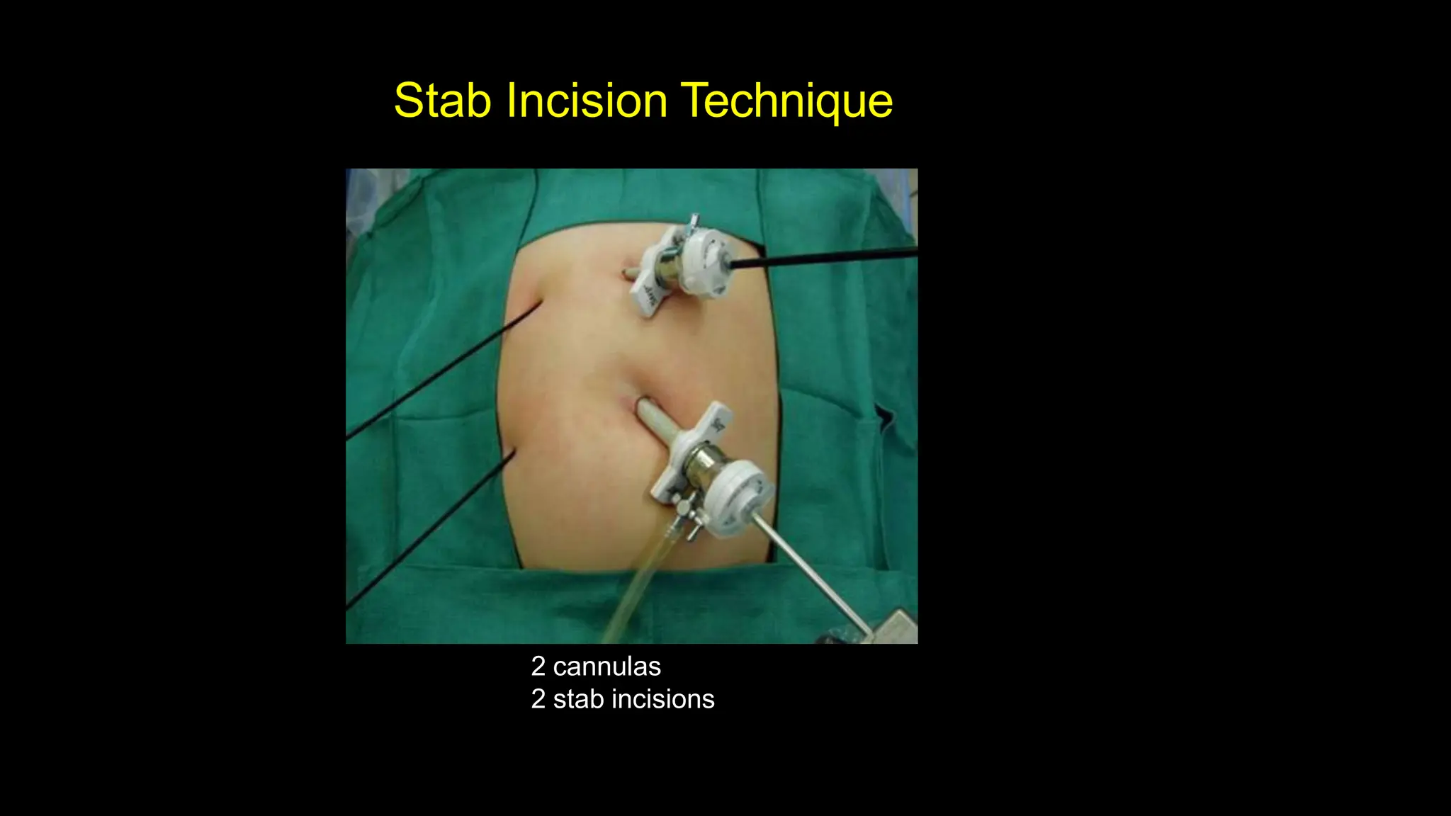 Abdominal Access Techniques in laparoscopy | PPT