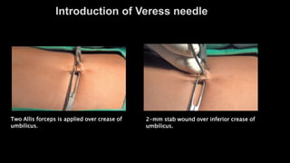 Abdominal Access Techniques in laparoscopy | PPTX