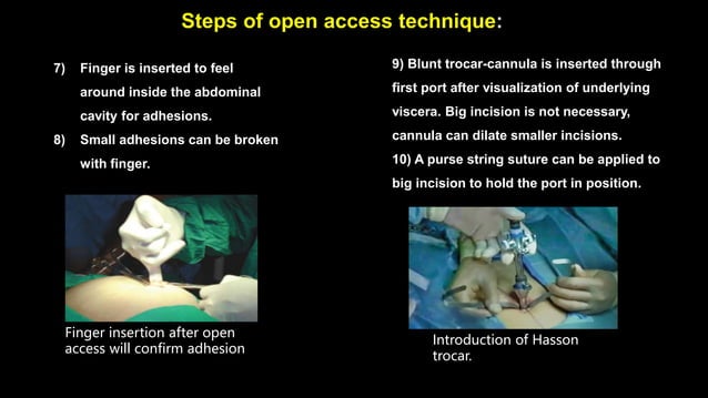 Abdominal Access Techniques in laparoscopy | PPT