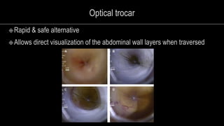 Abdominal Access Techniques in laparoscopy | PPTX