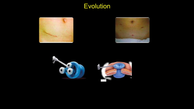 Abdominal Access Techniques in laparoscopy | PPT