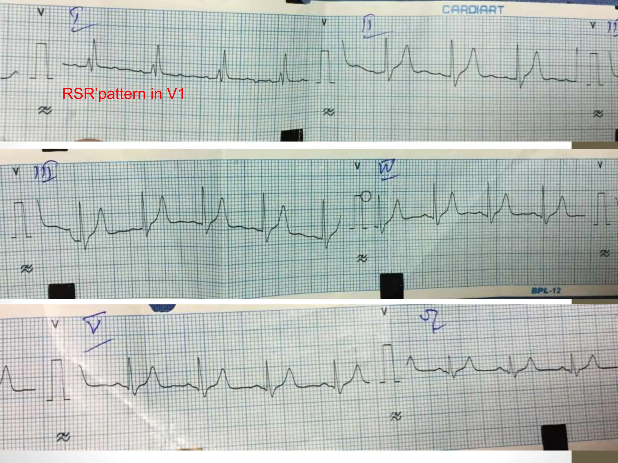 a case of abdominal aorta aneurysm-- AAA | PPTX