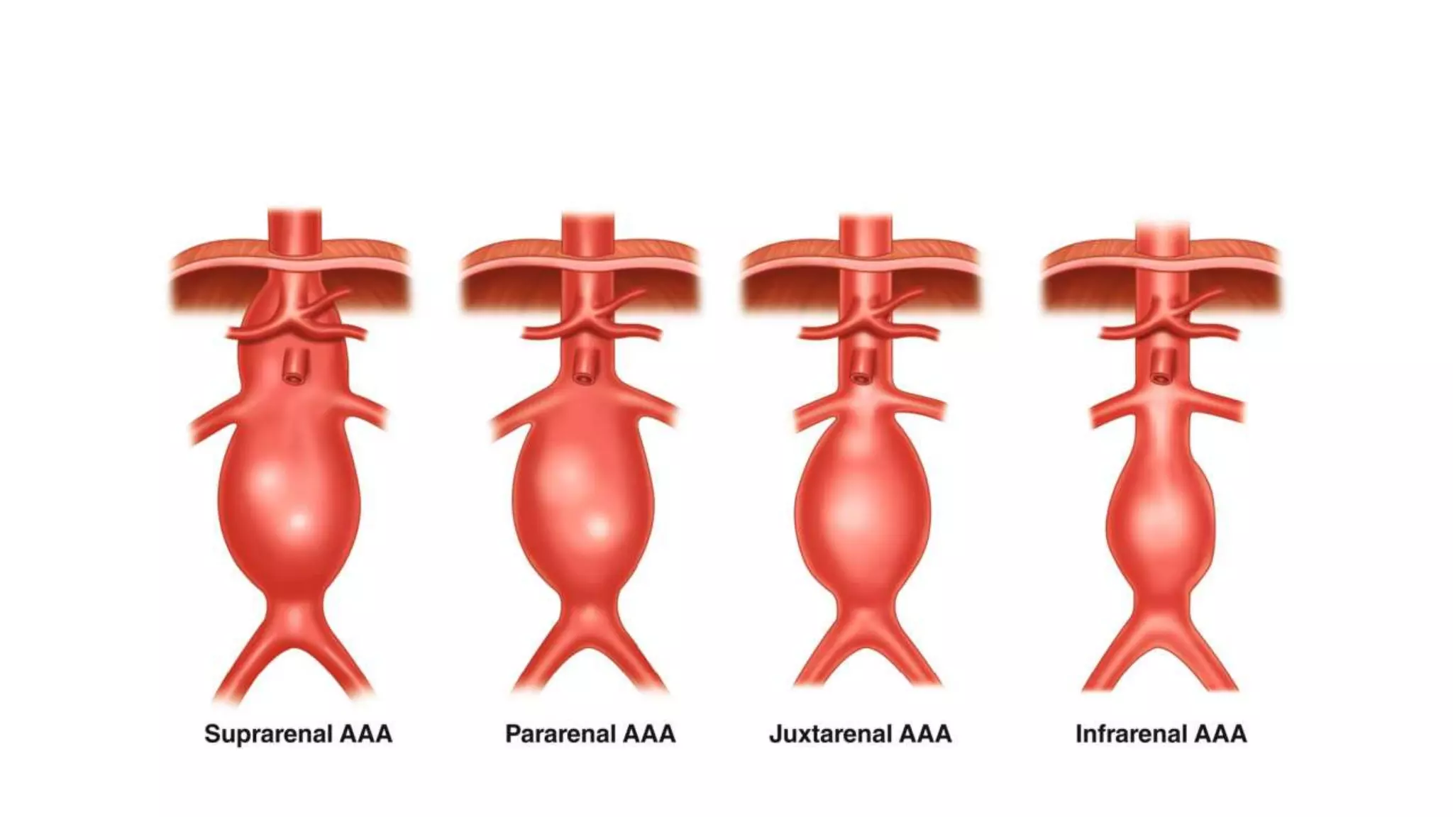 Abdominal aortic aneurysm | PPTX
