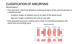 Abdominal aortic aneurysm | PPTX
