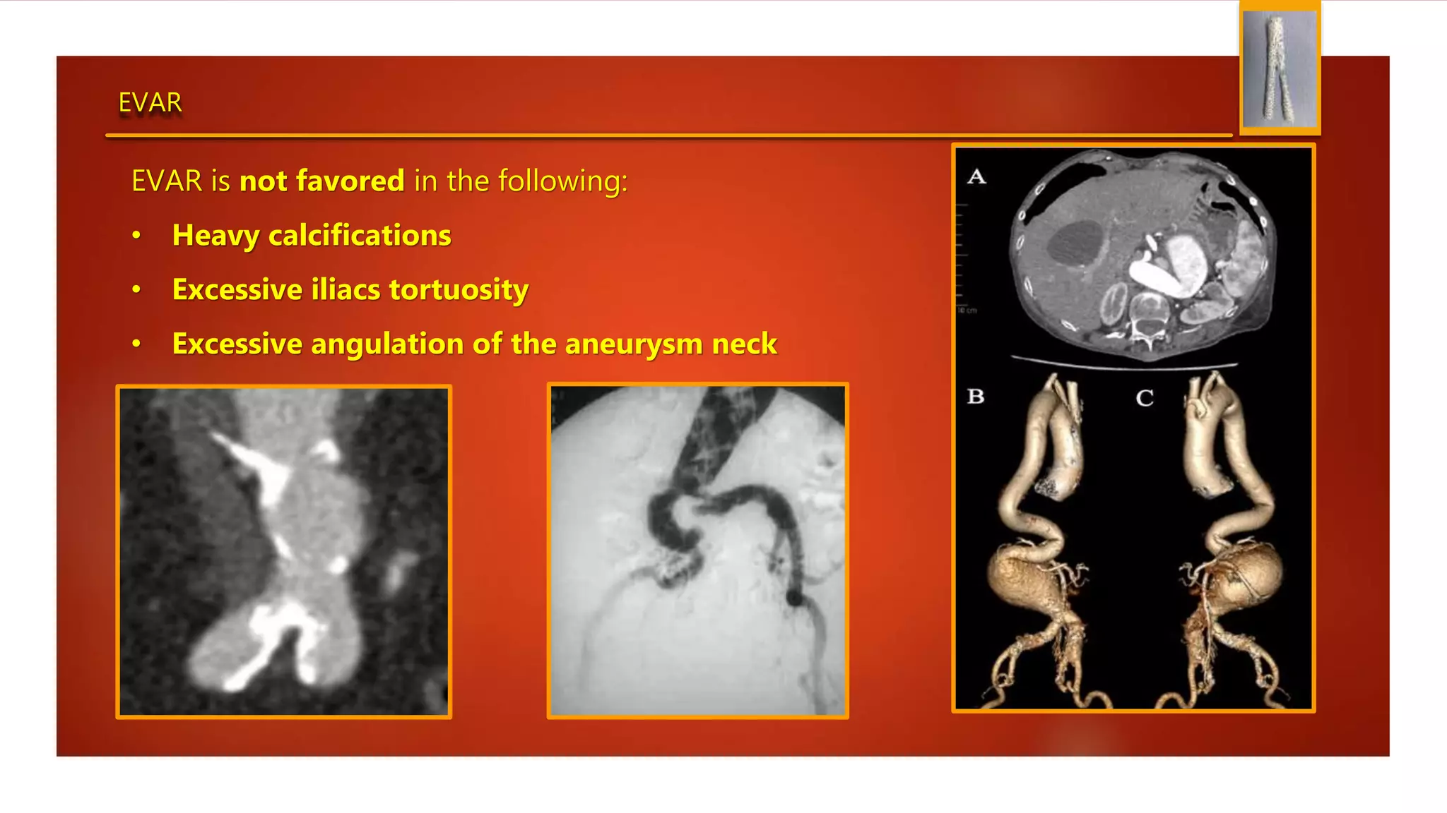 Endovascular Aortic Aneurysm Repair | PPTX