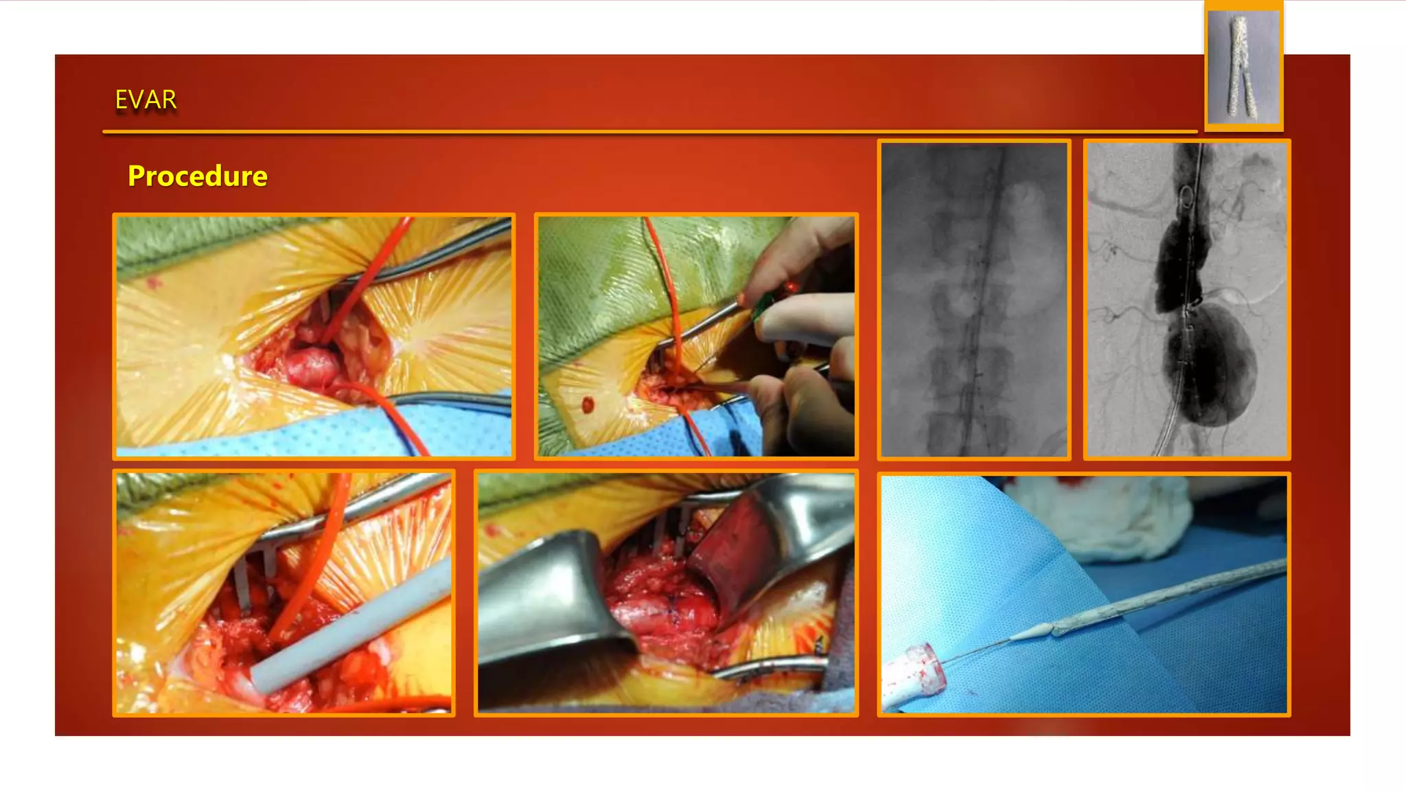 Endovascular Aortic Aneurysm Repair | PPTX