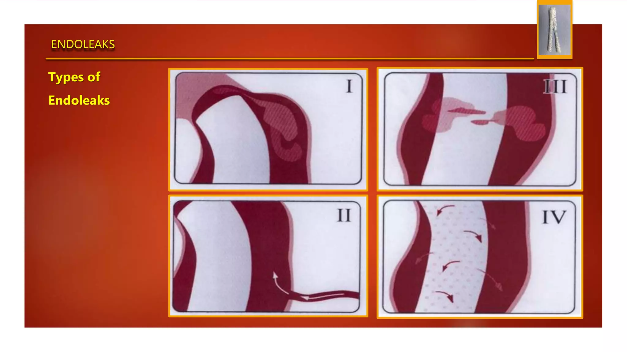 Endovascular Aortic Aneurysm Repair | PPTX