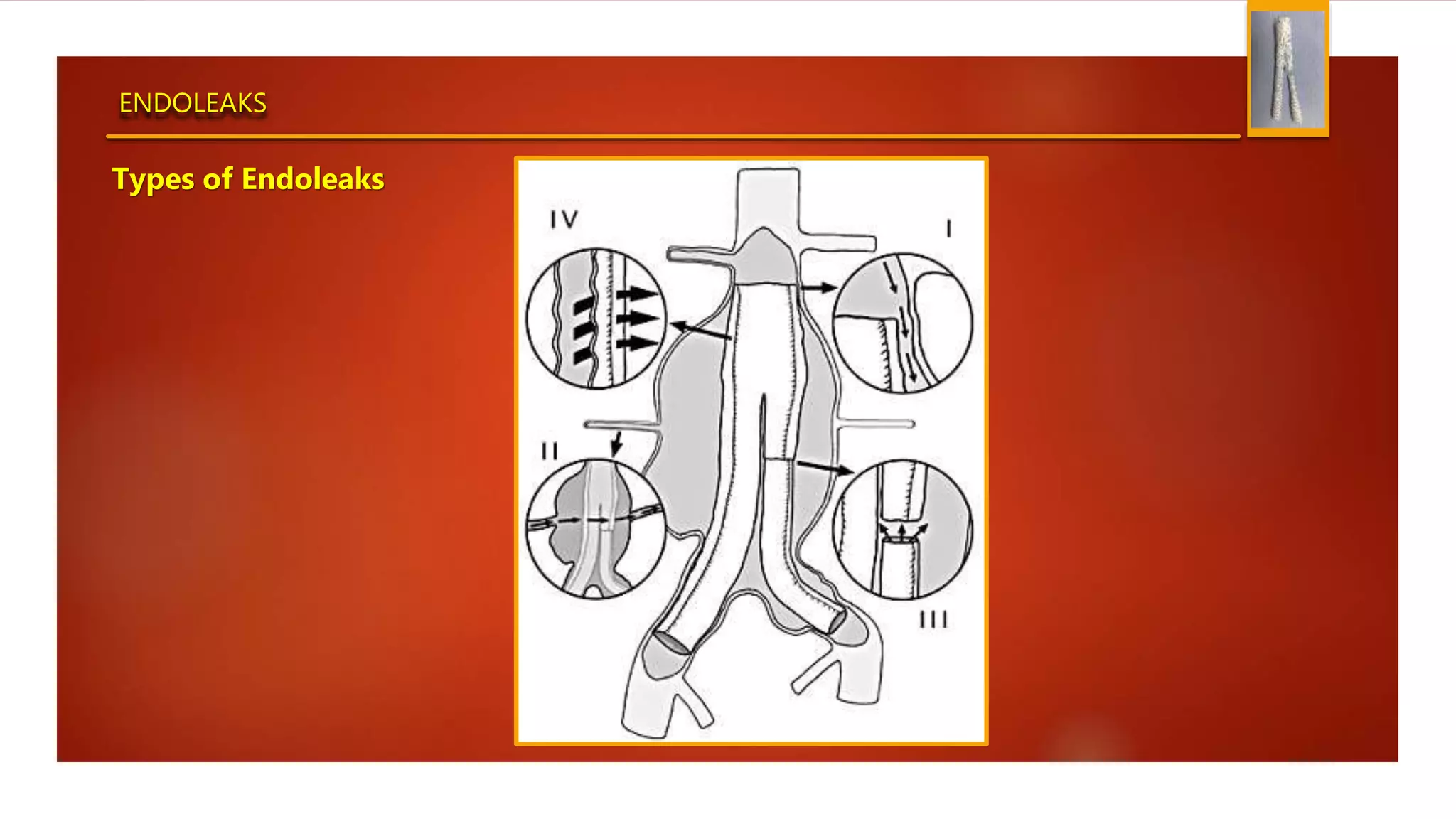 Endovascular Aortic Aneurysm Repair | PPTX