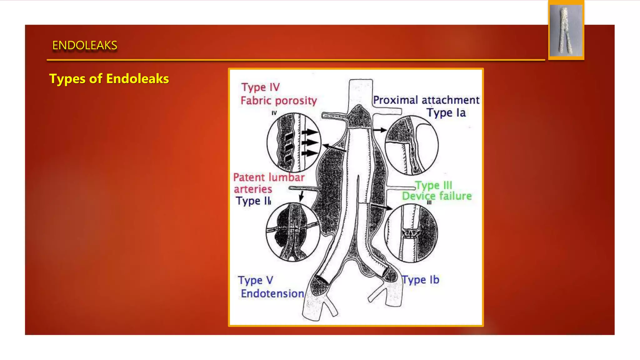 Endovascular Aortic Aneurysm Repair | PPTX