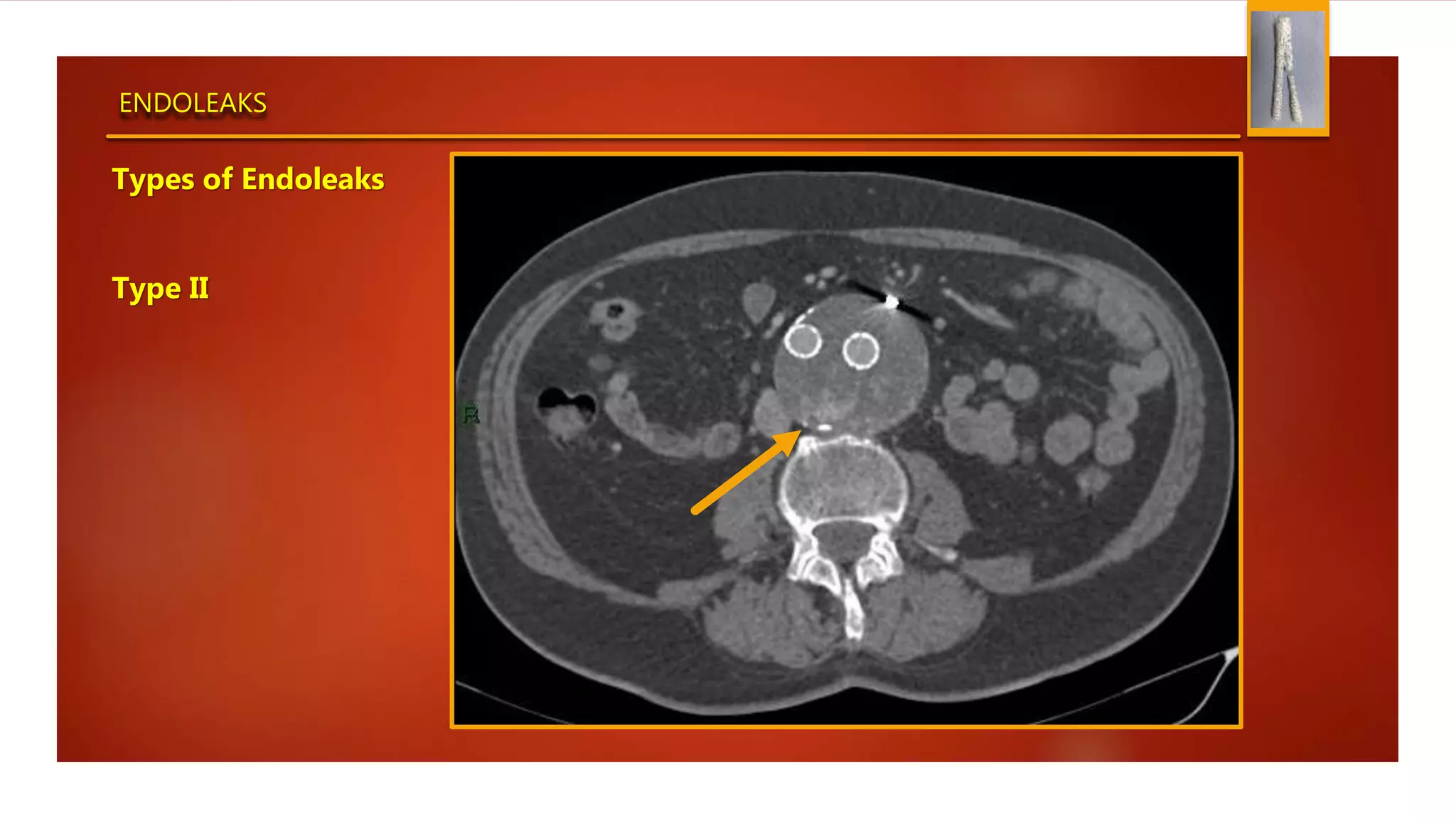 Endovascular Aortic Aneurysm Repair | PPTX