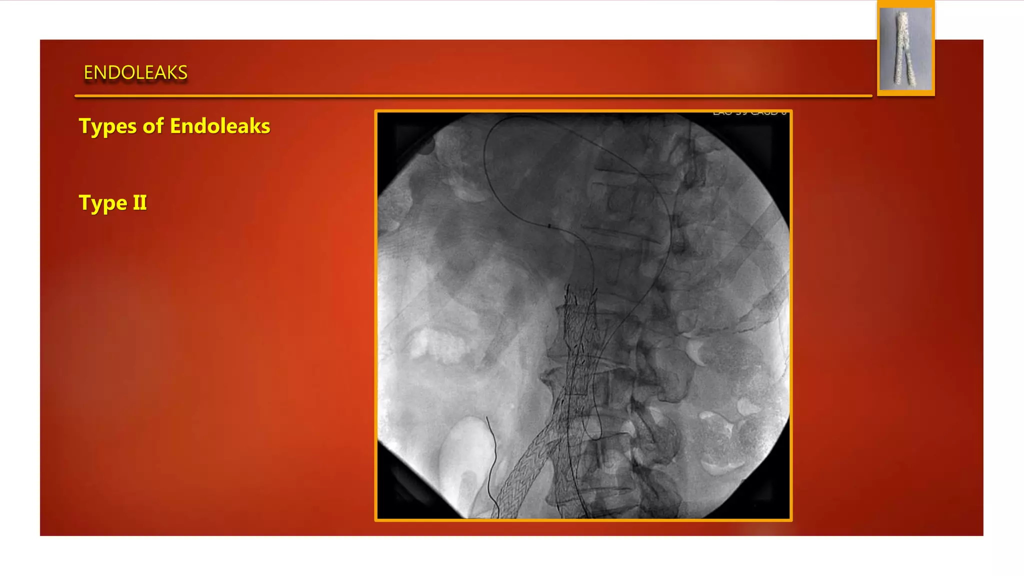 Endovascular Aortic Aneurysm Repair | PPTX