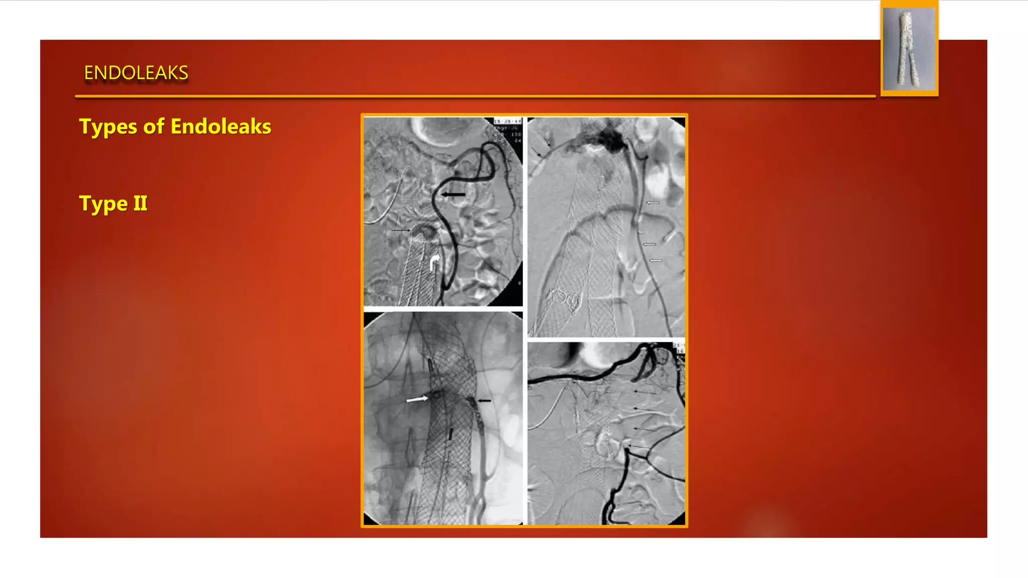Endovascular Aortic Aneurysm Repair | PPTX