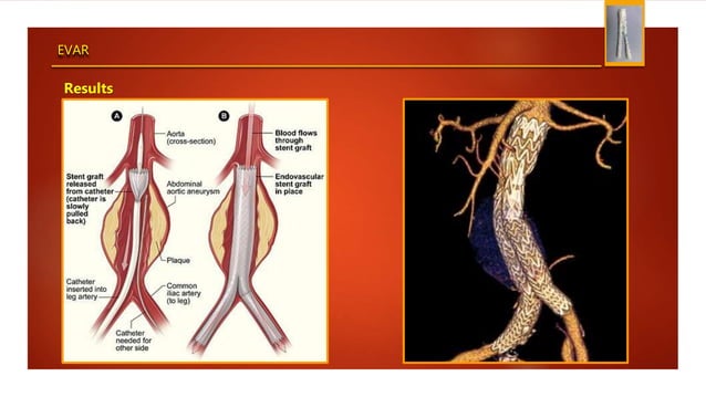 Endovascular Aortic Aneurysm Repair | PPTX