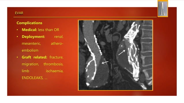 Endovascular Aortic Aneurysm Repair | PPTX