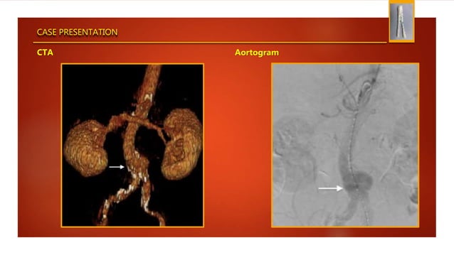 Endovascular Aortic Aneurysm Repair | PPTX