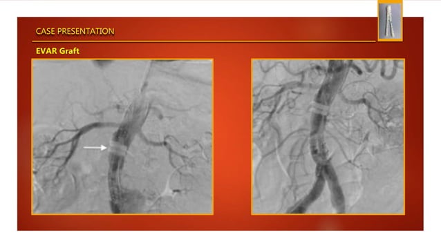 Endovascular Aortic Aneurysm Repair | PPTX