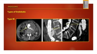 Endovascular Aortic Aneurysm Repair | PPTX