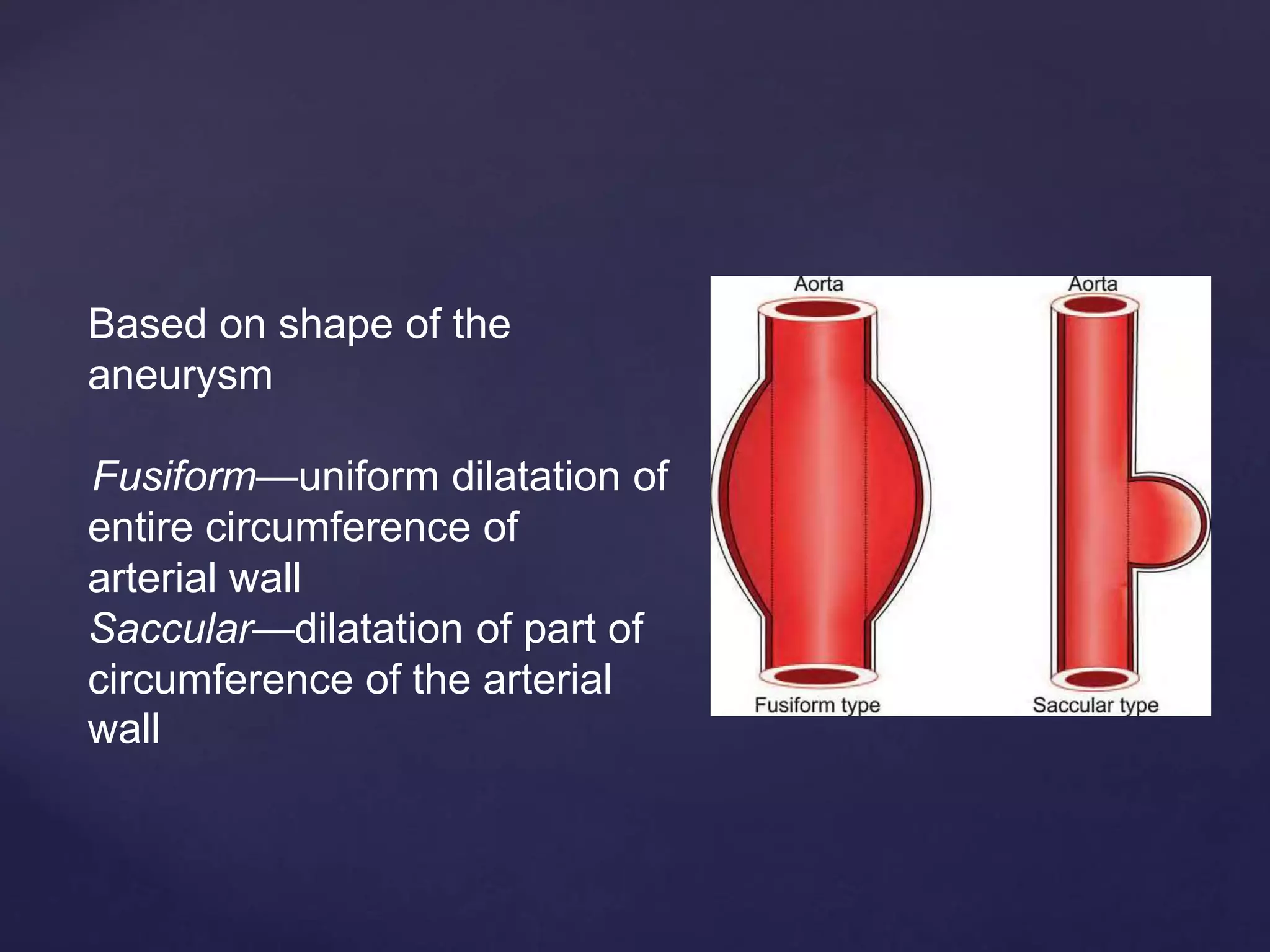 Abdominal aortic aneurysm | PPTX