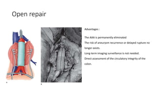 Abdominal Aortic neurysm.pptx
