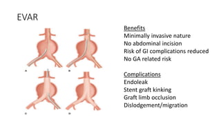 Abdominal Aortic neurysm.pptx