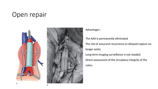 Abdominal Aortic aneurysm intro till management .pptx
