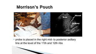 Abdominal Blunt Trauma and Damage Control Surgery | PPT