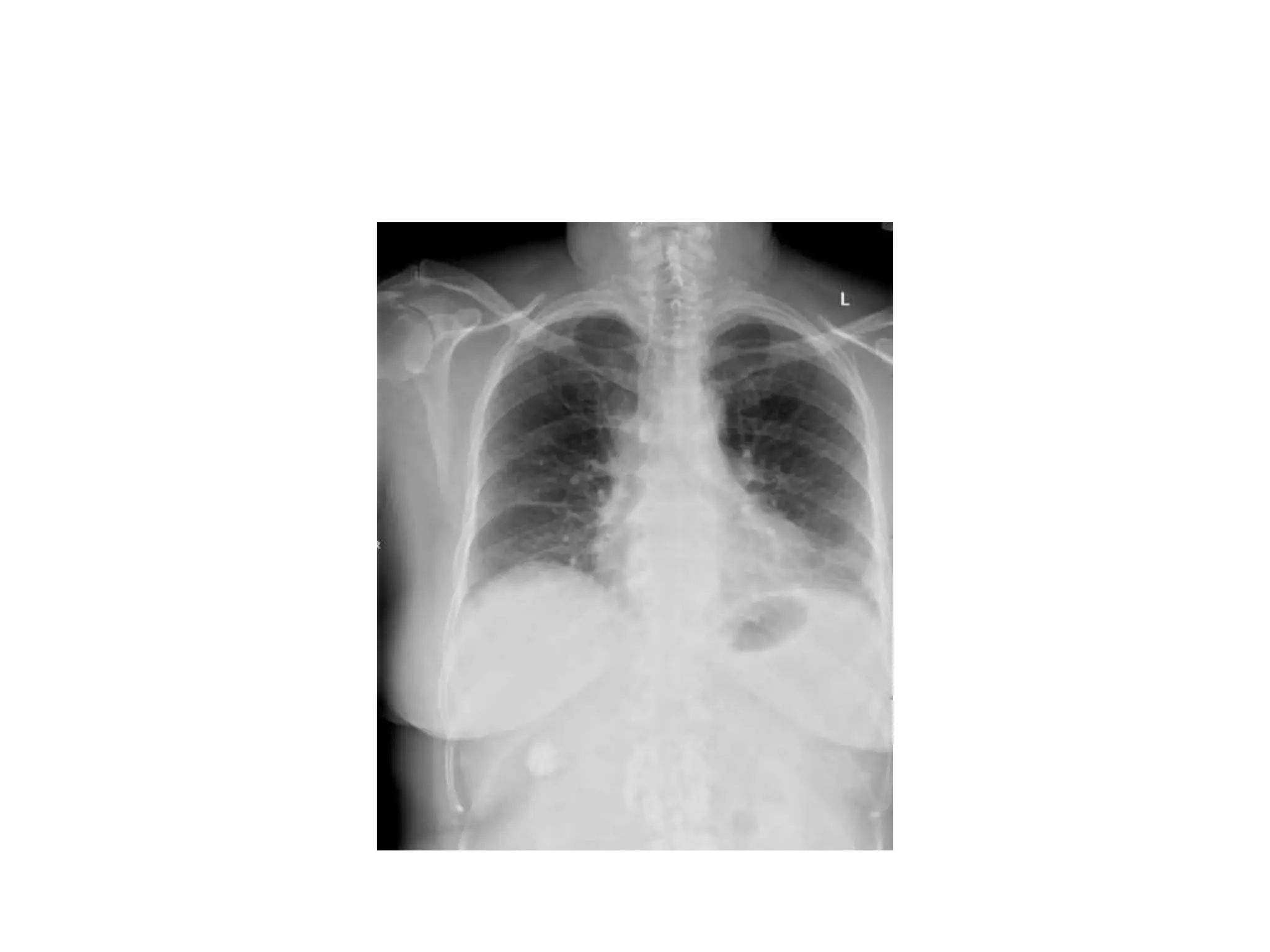 ABDOMINAL CALCIFICATIONS.pptx