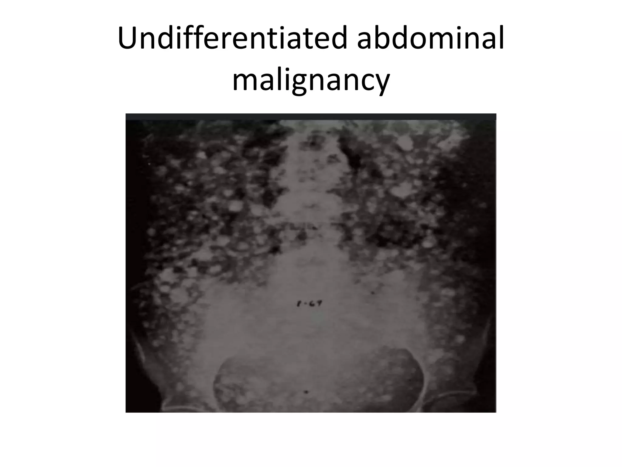 ABDOMINAL CALCIFICATIONS.pptx