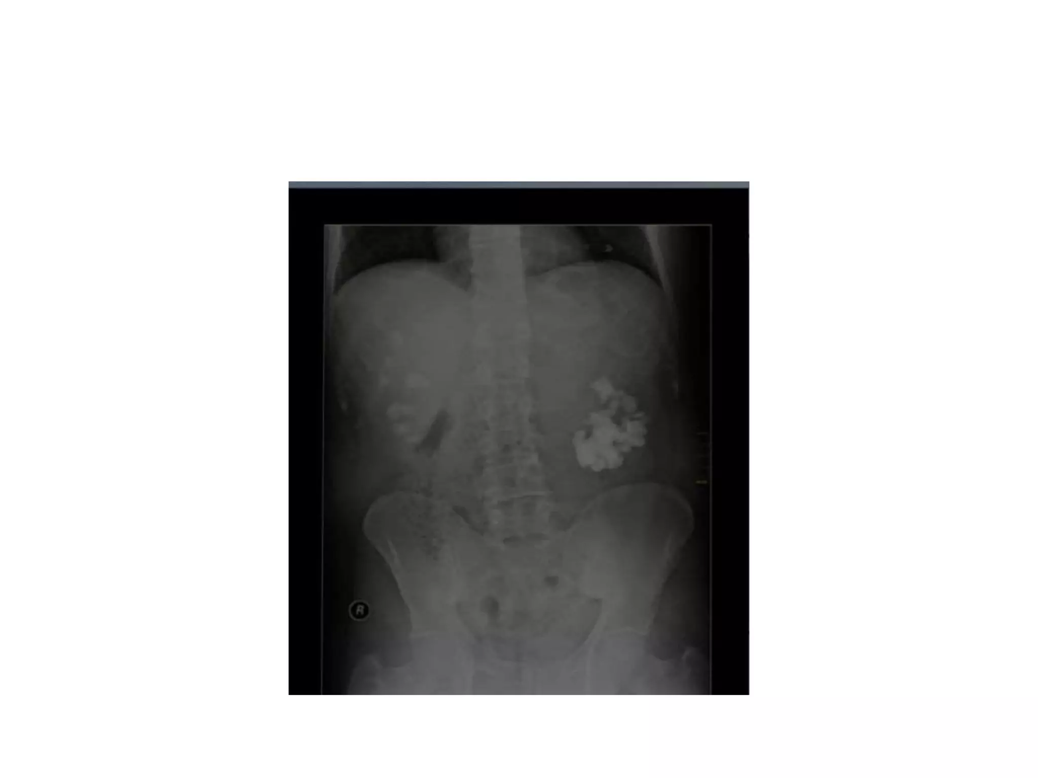 ABDOMINAL CALCIFICATIONS.pptx