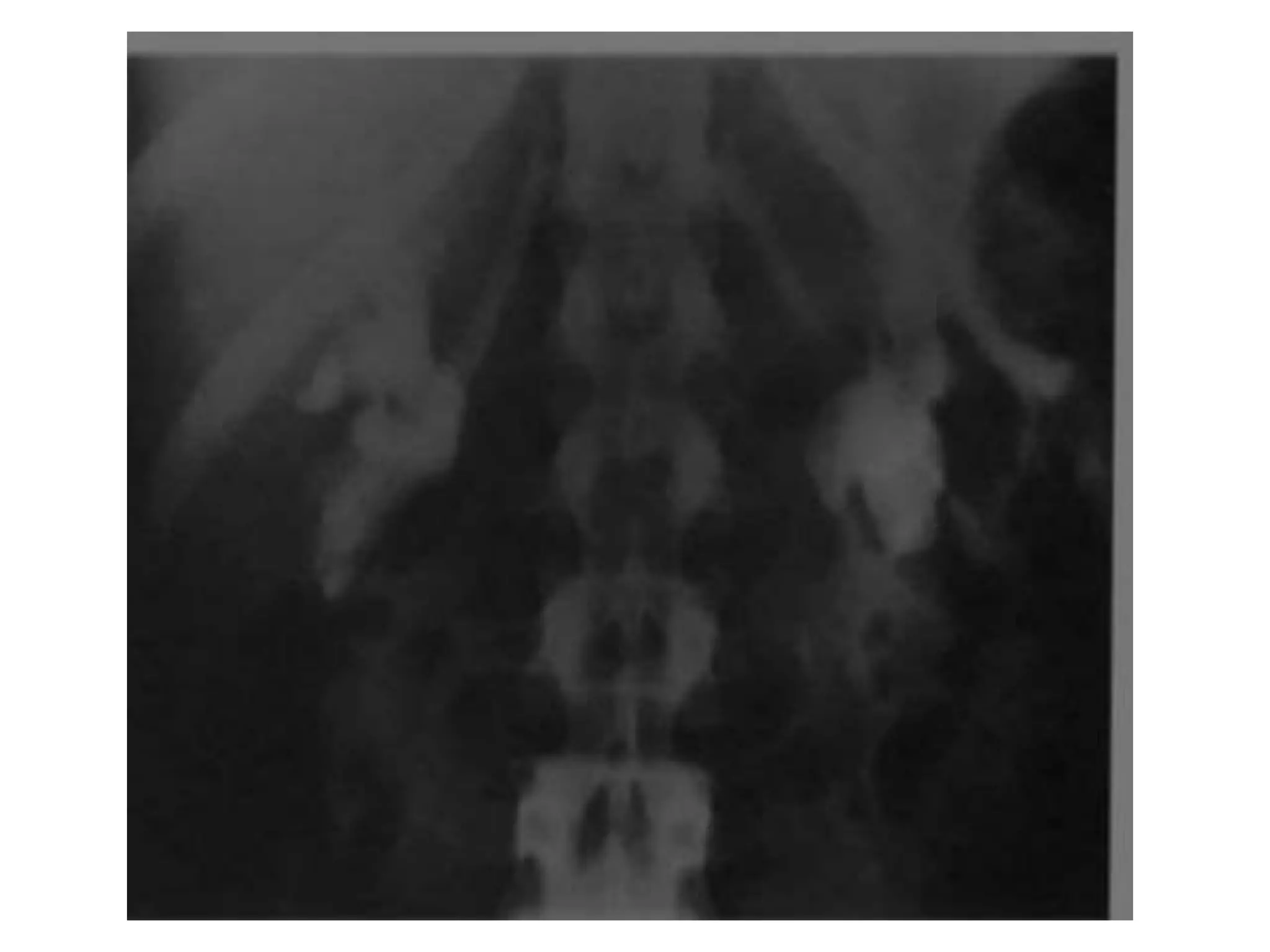 ABDOMINAL CALCIFICATIONS.pptx