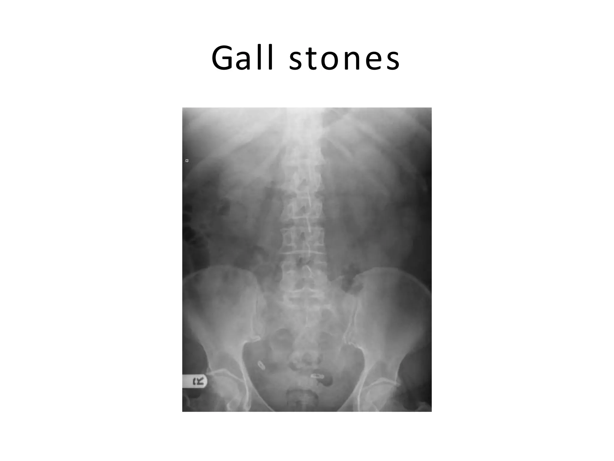 ABDOMINAL CALCIFICATIONS.pptx | Digestive Disorders | Diseases and ...