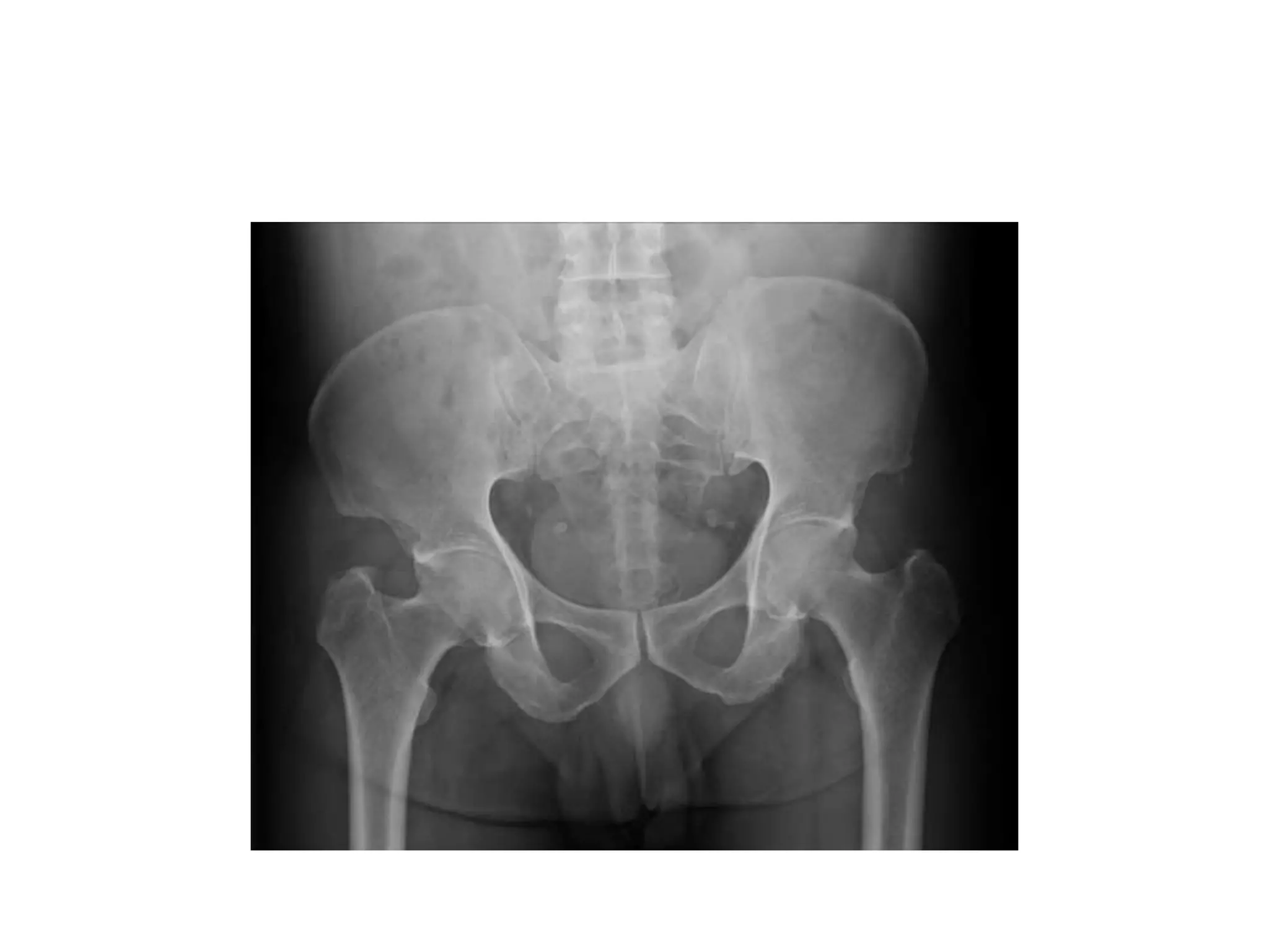 ABDOMINAL CALCIFICATIONS.pptx | Digestive Disorders | Diseases and ...