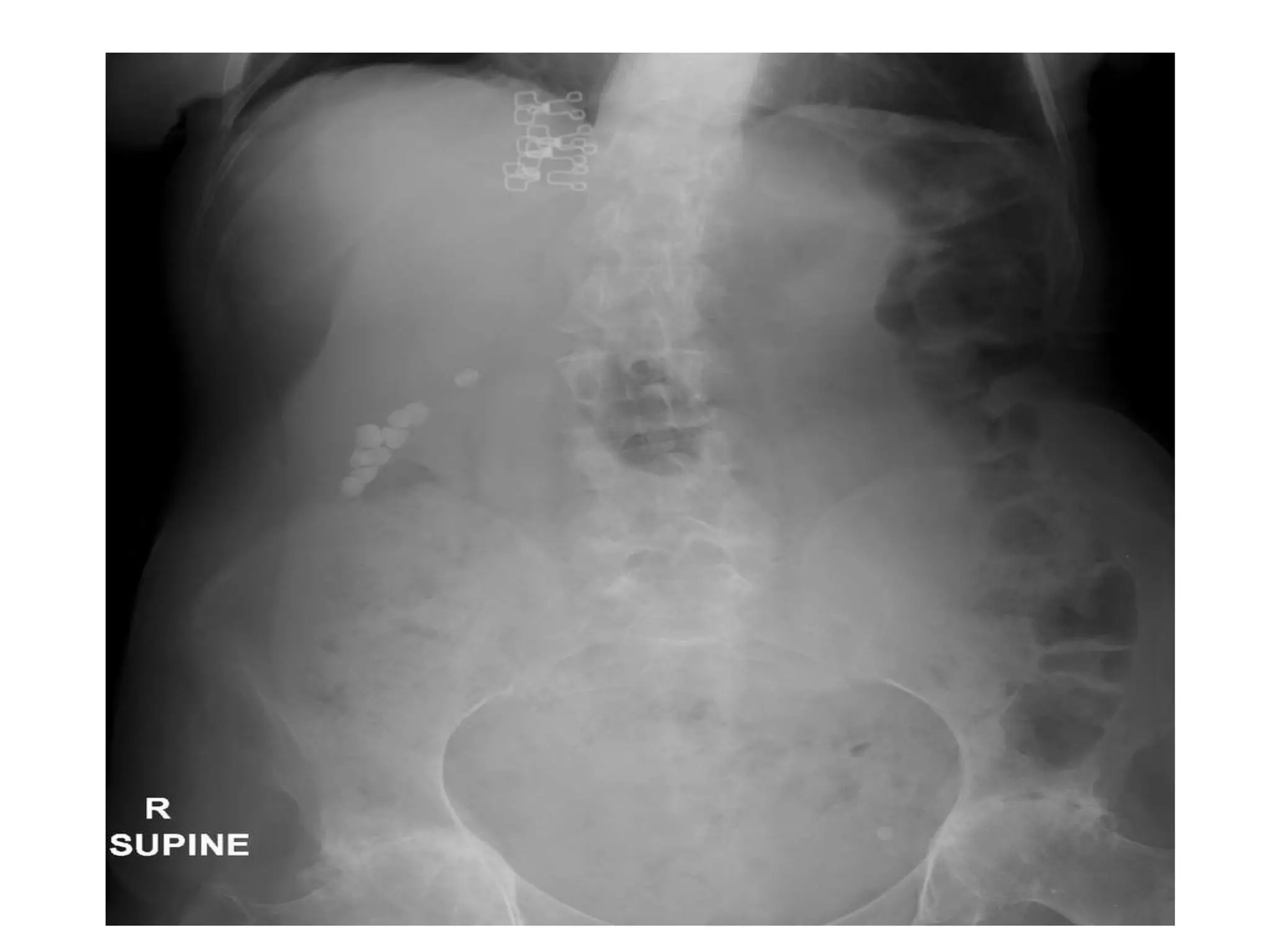 ABDOMINAL CALCIFICATIONS.pptx | Digestive Disorders | Diseases and ...