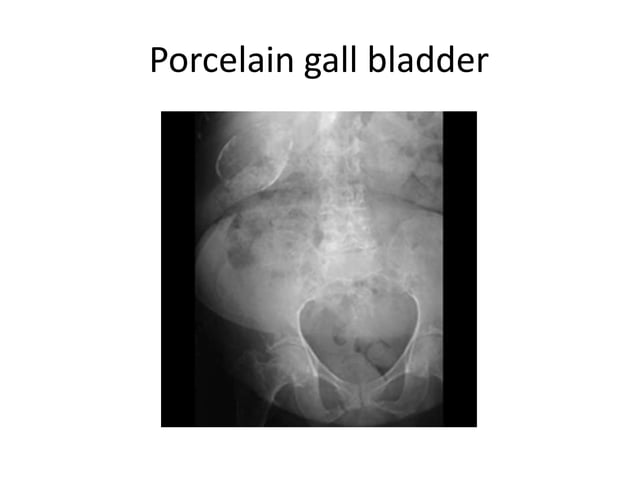 ABDOMINAL CALCIFICATIONS.pptx | Digestive Disorders | Diseases and ...