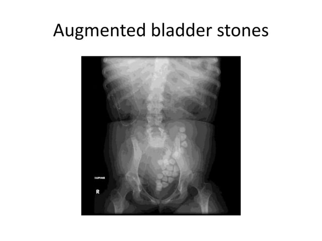 ABDOMINAL CALCIFICATIONS.pptx | Digestive Disorders | Diseases and ...