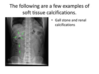 ABDOMINAL CALCIFICATIONS.pptx | Digestive Disorders | Diseases and ...