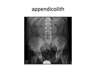 ABDOMINAL CALCIFICATIONS.pptx | Digestive Disorders | Diseases and ...