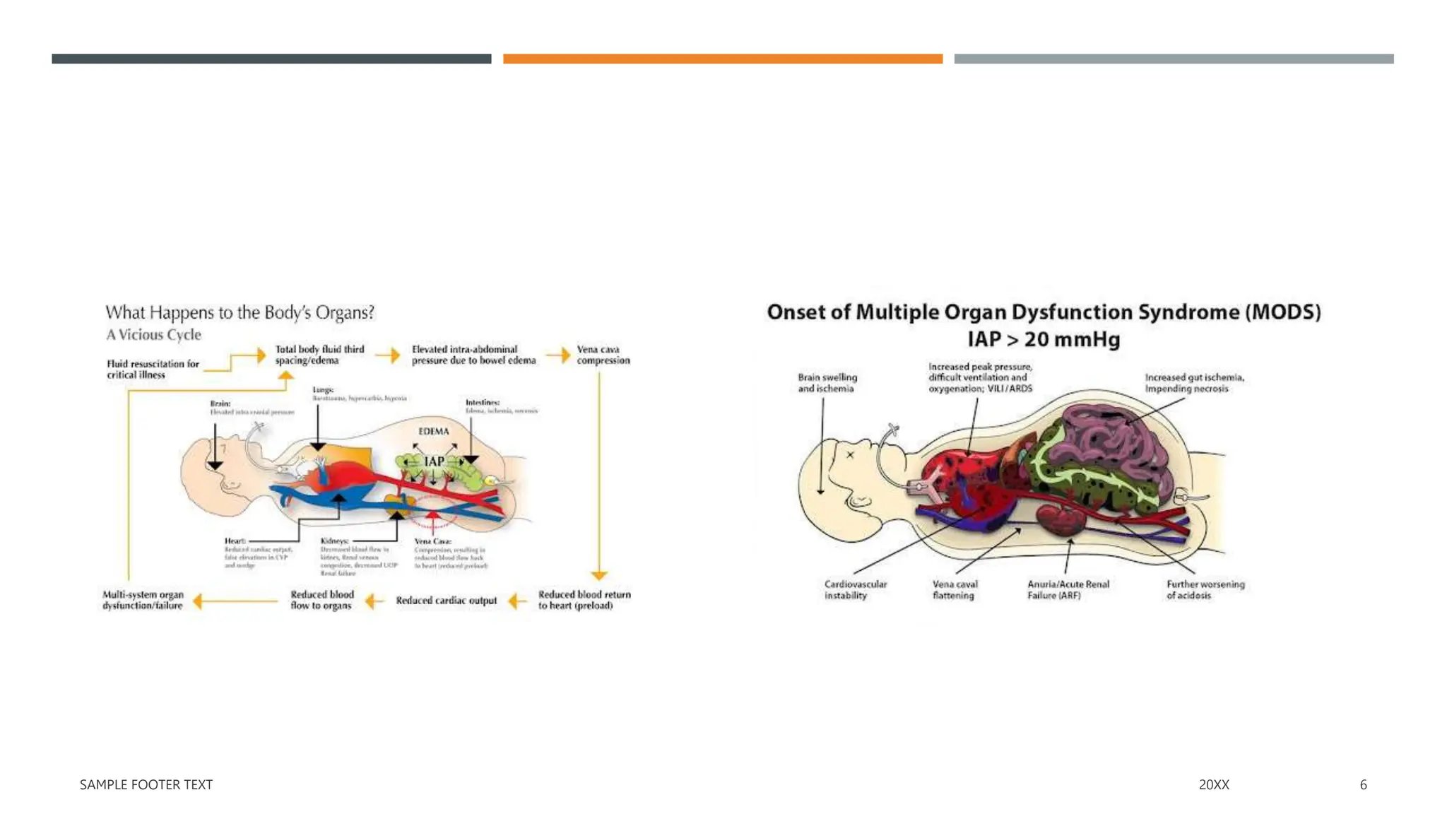 Abdominal compartment syndrome powerpoint slides | PPT