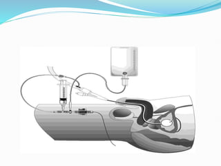 Abdominal compartment syndrome (ACS) .pptx