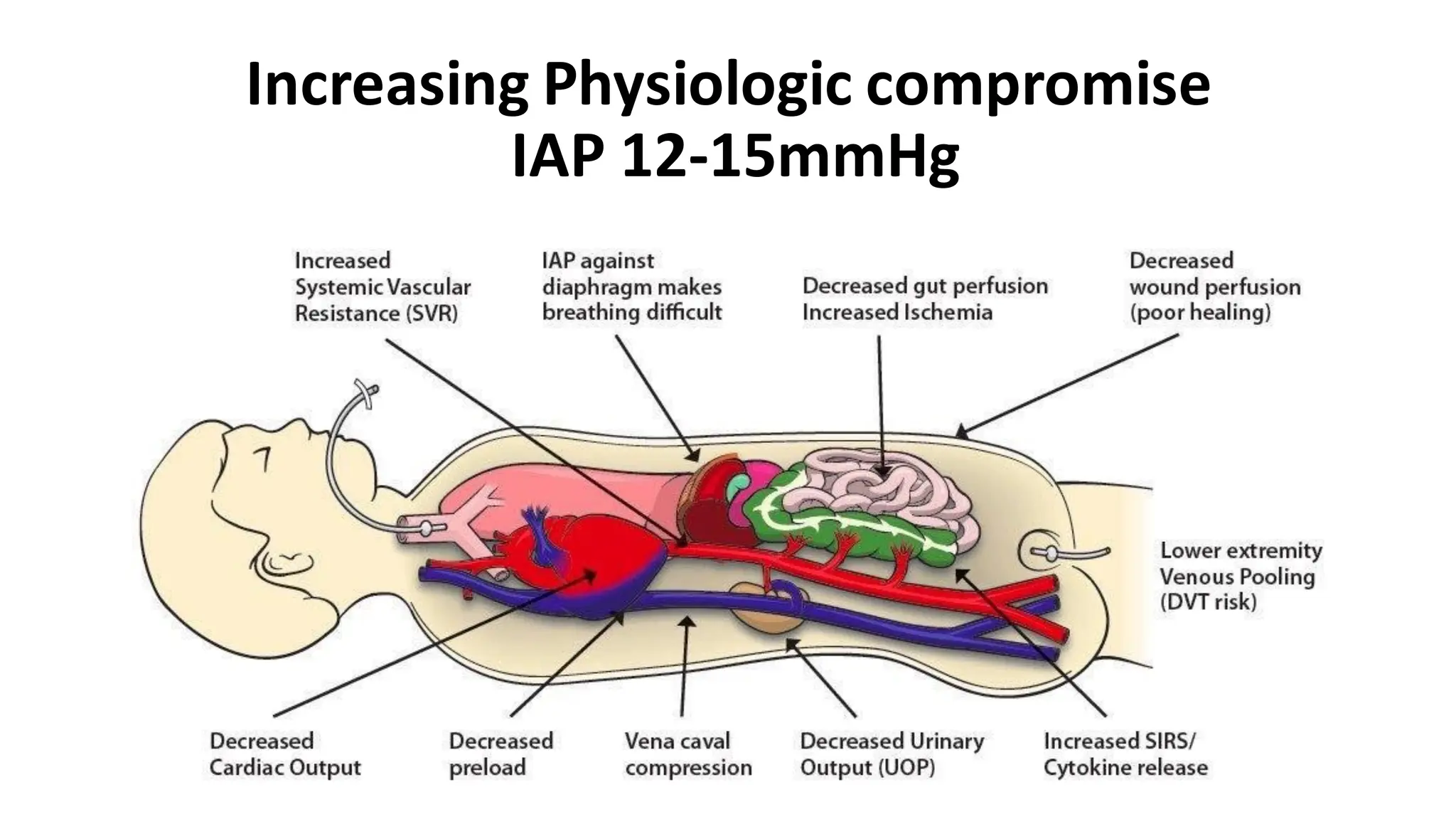 Abdominal Compartment Syndrome definition,presentation and managememt | PPT