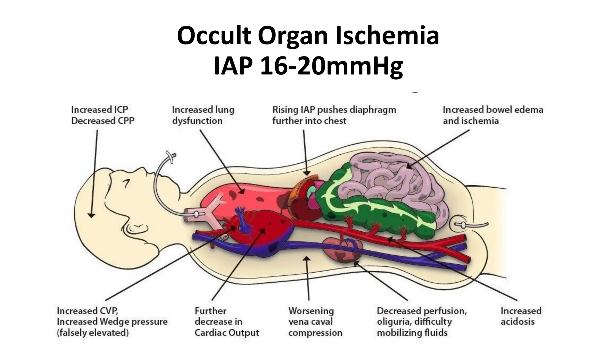 Abdominal Compartment Syndrome definition,presentation and managememt | PPT