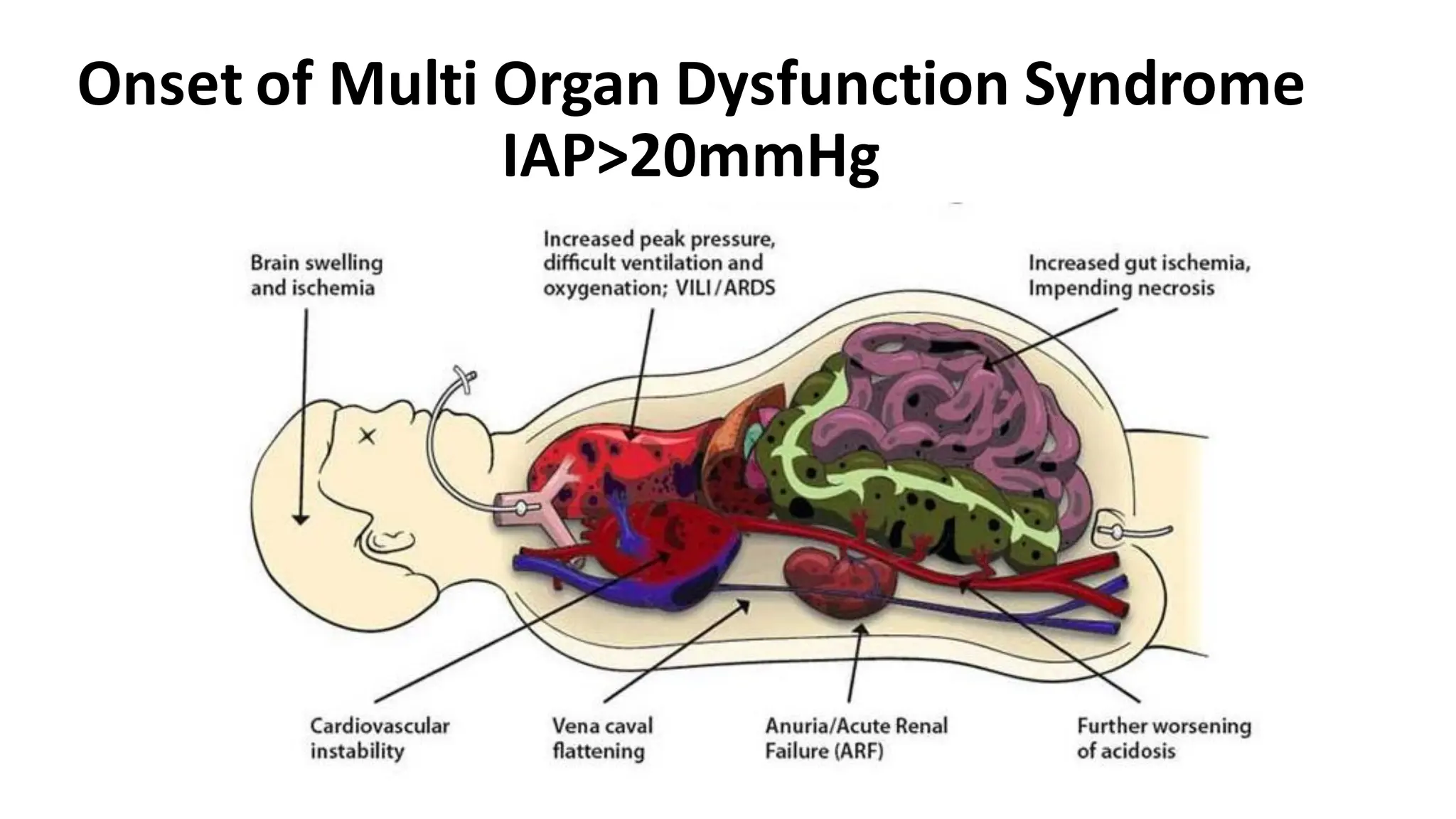 Abdominal Compartment Syndrome definition,presentation and managememt | PPT
