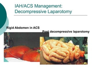 Abdominal compartment syndrome[1] | PPTX