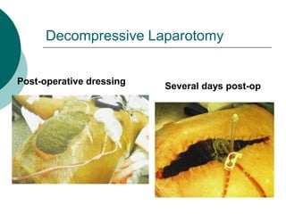 Abdominal compartment syndrome[1] | PPTX