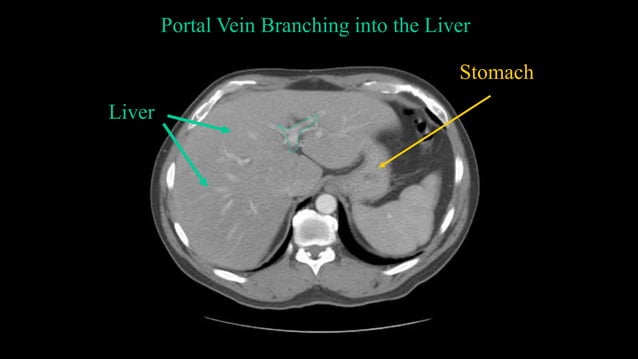 Abdominal CT scan | PPTX | Digestive Disorders | Diseases and Conditions