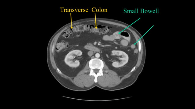 Abdominal CT scan | PPTX | Digestive Disorders | Diseases and Conditions