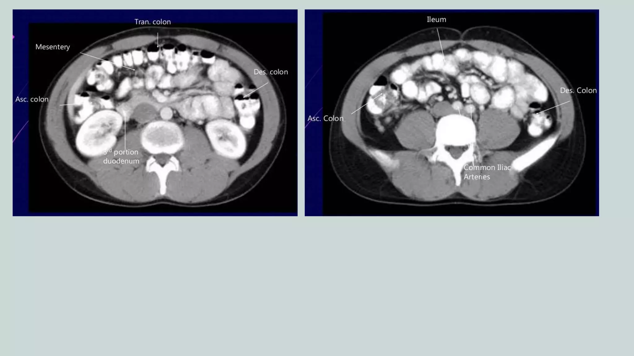 ABDOMINAL CT SCAN.pptx