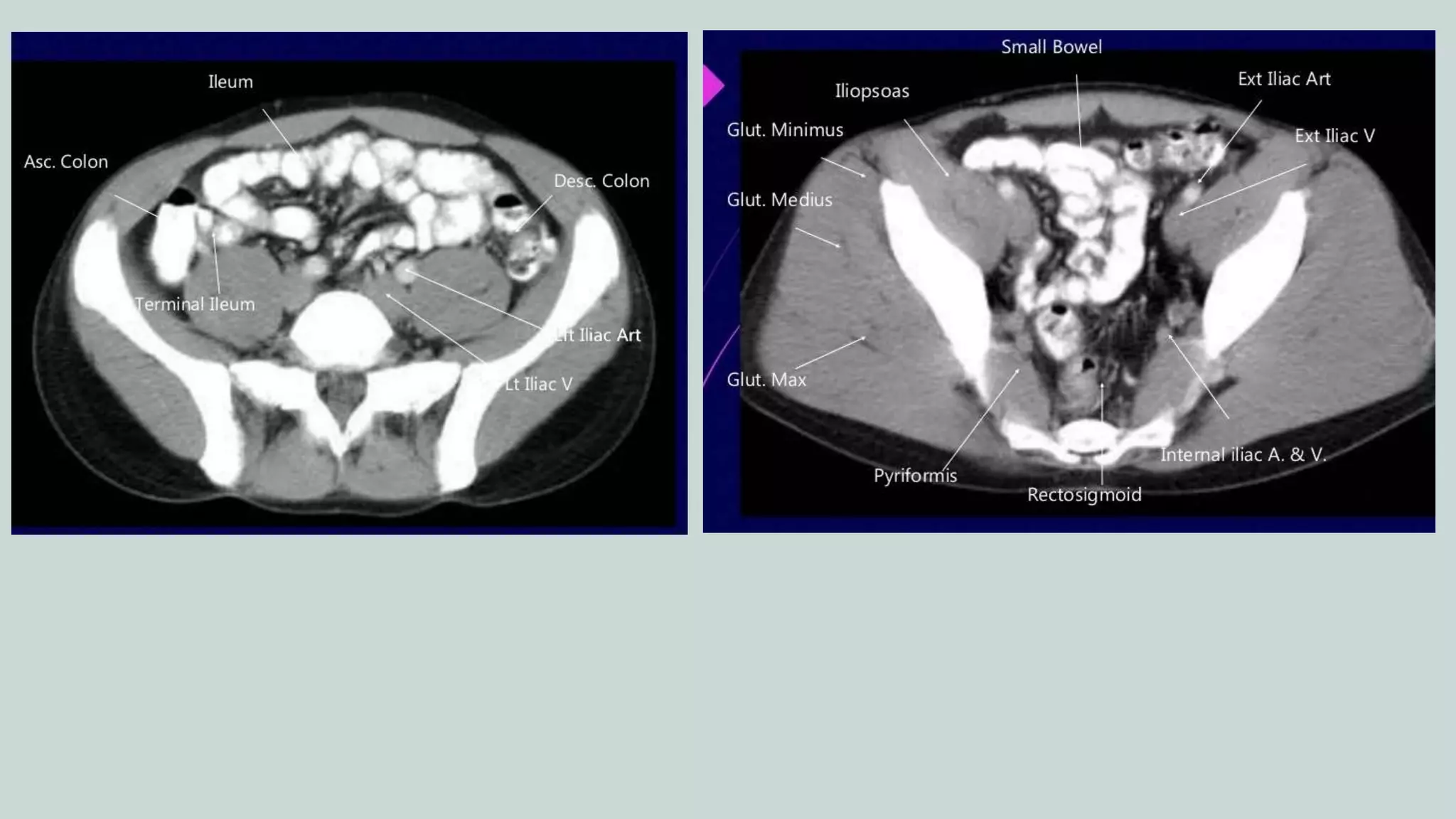 ABDOMINAL CT SCAN.pptx