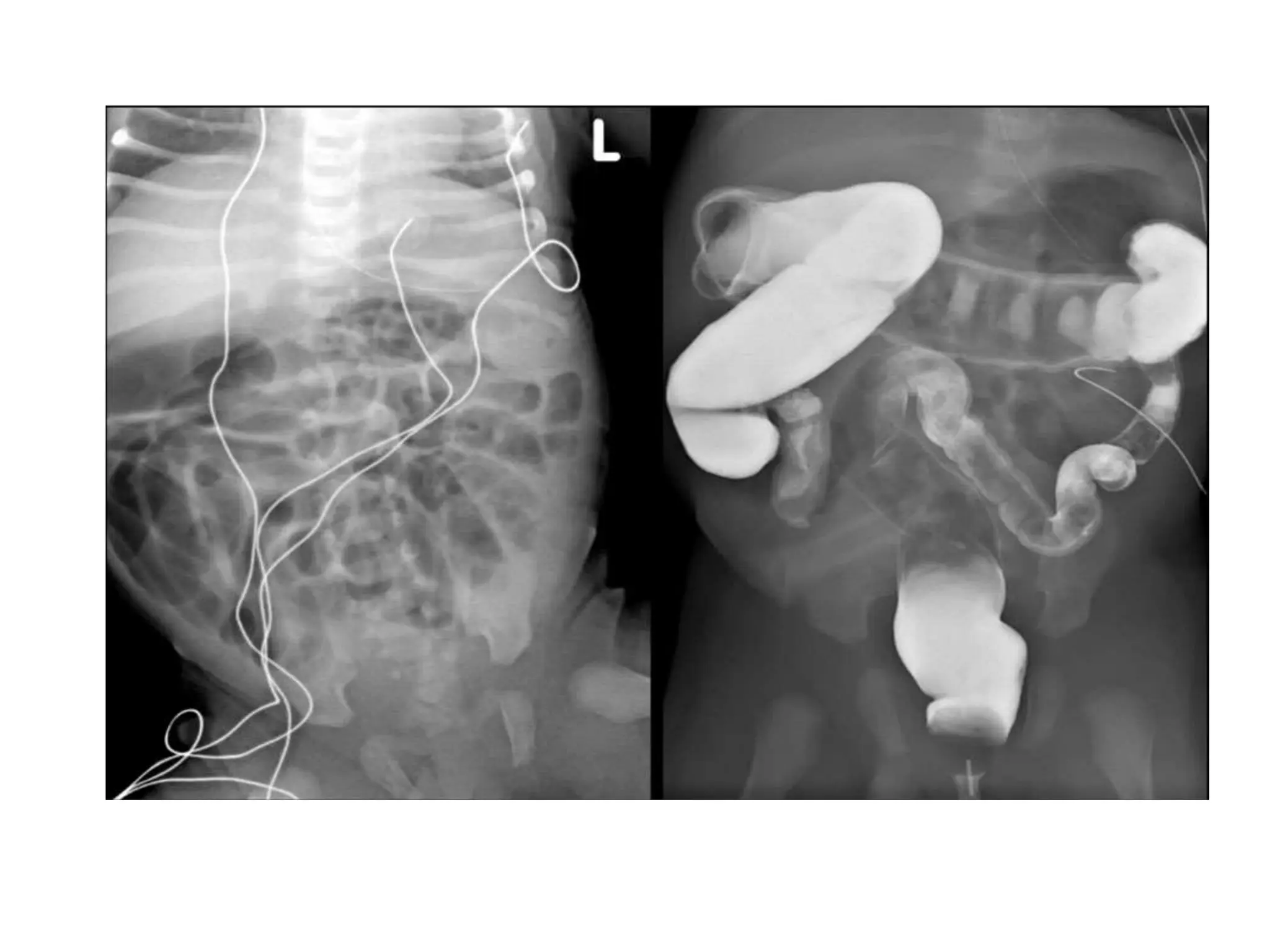 Abdominal Distension in Neonates Part 2.pptx